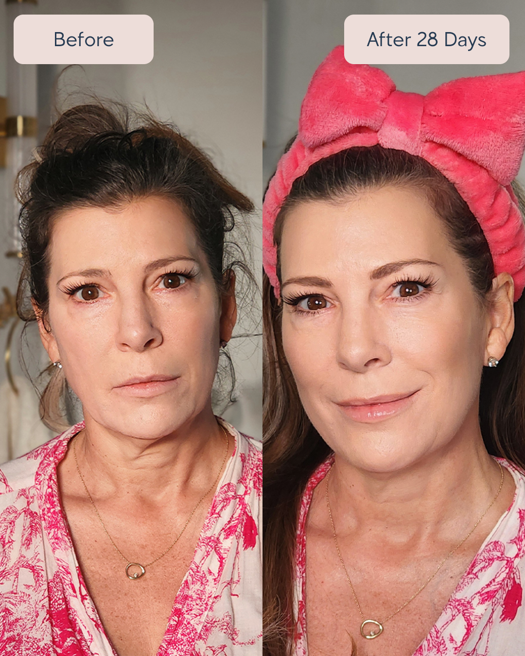 RenewaLift Device – Renewa Skin